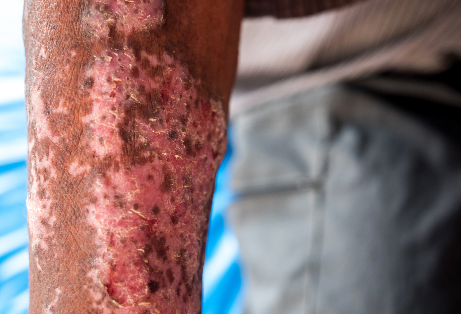 The Many Shades of Psoriasis - Institute for Natural Medicine